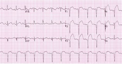 Study Medical Photos Acute Anterior Myocardial Infarction Ecg Images