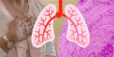 Les symptômes d une embolie pulmonaire Marie Claire