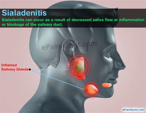 Sialadenitis Salivary Gland Infection Current Health Advice Health