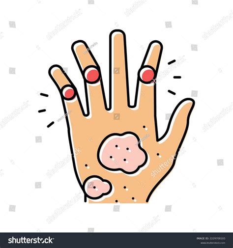 180 Psoriatic Arthritis Icons Images Stock Photos Vectors Shutterstock