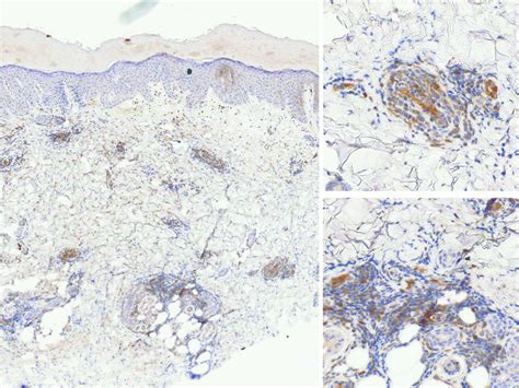 Myxovirus Resistance Protein A MxA Staining Of Lesional Skin