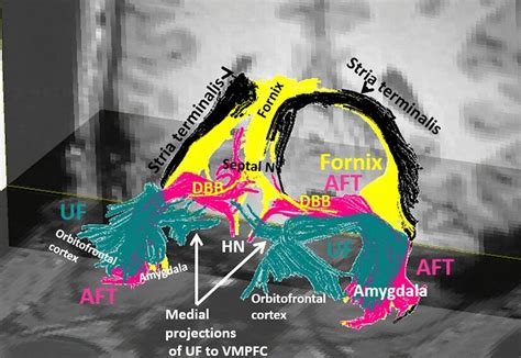Represents The D Fiber Reconstruction Of The Fornix Yellow Stria