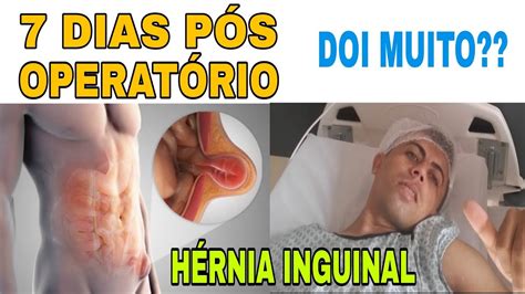 COMO É O PÓS OPERATÓRIO DA HÉRNIA INGUINAL YouTube