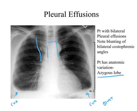 Pleural Effusions Flashcards Quizlet