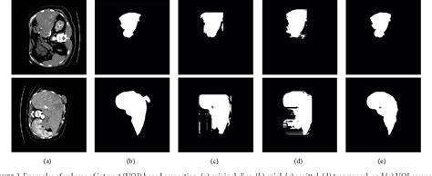 figure 1 from a low interaction automatic 3d liver segmentation method using computed tomography