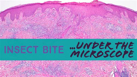 Bug Bite Under The Microscope Aka Arthropod Assault Patient Had