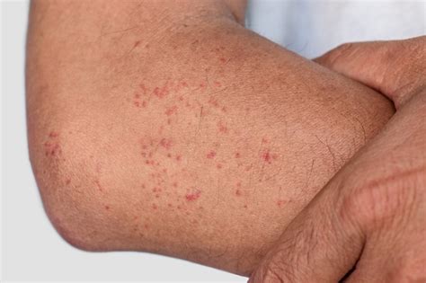 4 Penyebab Bintik Merah Gatal Menyebar Alodokter