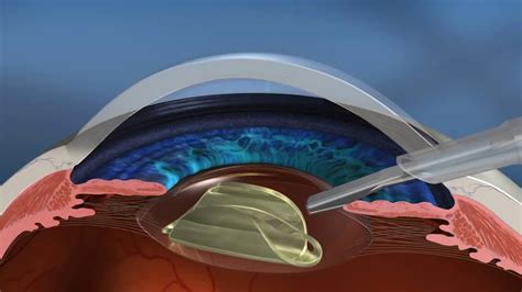 Cirurgia De Catarata A Laser E Convencional YouTube
