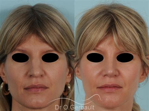 Rhinoplastie avant après photos et exemples de nez refaits