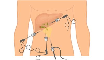 Gallbladder Stones Symptoms Causes Pain Surgery And Treatment