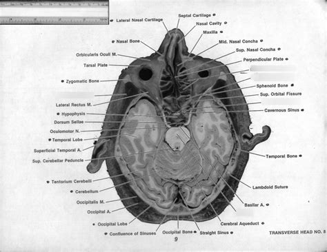 CADAVER CROSS SECTIONS FOR HEAD AND NECK Diagram Quizlet