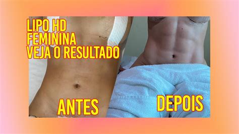 LIPO HD FEMININA RESULTADO O QUE FIZEMOS CIRURGIA PLÁSTICA YouTube