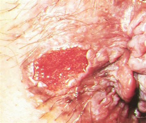 Anal Cancer Symptoms