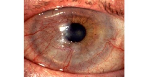 Complications Of Contact Lens Wear New