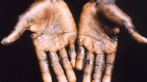 Quali Sono I Sintomi Del Virus Del Vaiolo Delle Scimmie Come Si