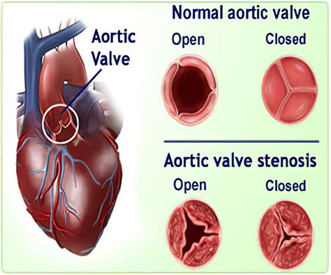 Normal Aortic Valve