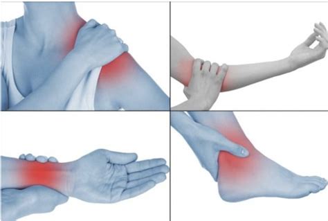 Tendinitis Y Bursitis Causas Y Tratamientos Sumed Xxi