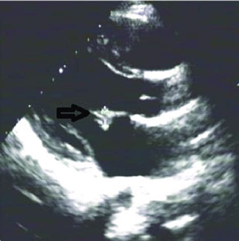 Myxomatous Degeneration Of Mitral Valve Prolapse Mitral Valve Images