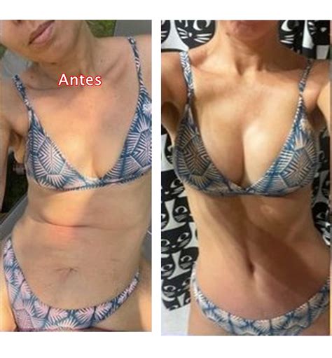 Abdominoplastia lipoescultura e mastopexia próteses de silicone de