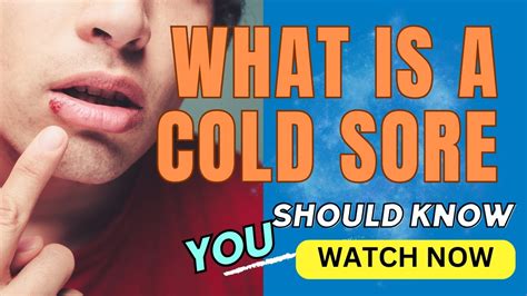 What Is Cold Sore What Does Cold Sore Look Like Definition Of Cold