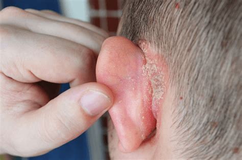 Scalp Psoriasis Overview Causes Symptoms Treatment And Prevention Factdr