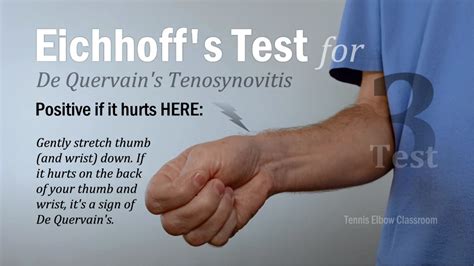 Quick Tests For De Quervains Syndrome Tenosynovitis Mommy Thumb
