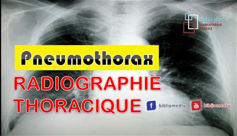 Pneumothorax Radiographie Pulmonaire