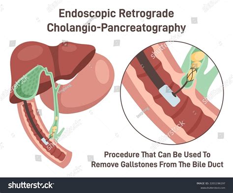 Ercp Shutterstock