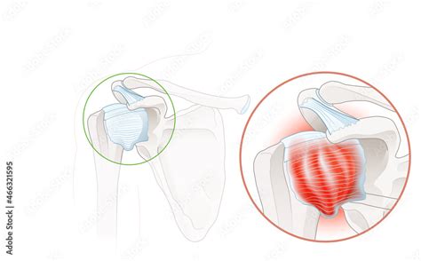 Frozen Shoulder Adhesive Capsulitis Surgery Labeled Illustration