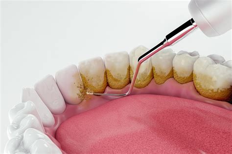 Diferencias entre Palca y Sarro dental Ortodoncia Castaños