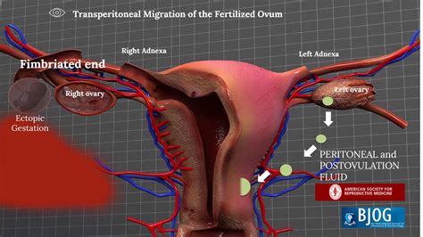 Transperitoneal Migration Of The Fertilized Ovum Youtube