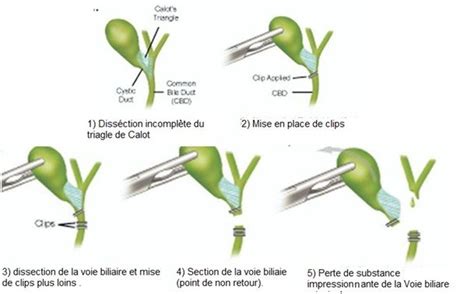 La Voie Biliaire Principale VBP Est Prise Pour Le Canal Cystique Une