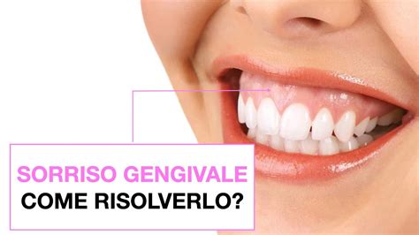 Sorriso Gengivale Come Risolverlo YouTube
