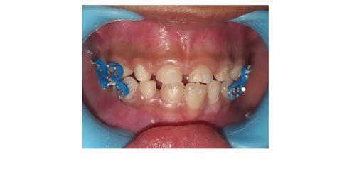 Conservative Management Of Mandibular Fracture With Maxillomandibular