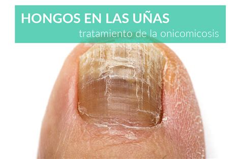 Hongos en las uñas tratamiento de la onicomicosis
