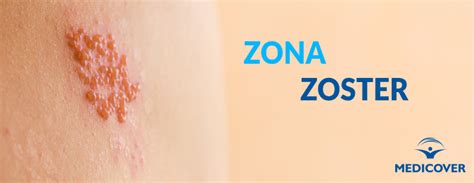 Nu Am Observat Lupt Deghizare Zona Zoster Cauze Simptome Tratament