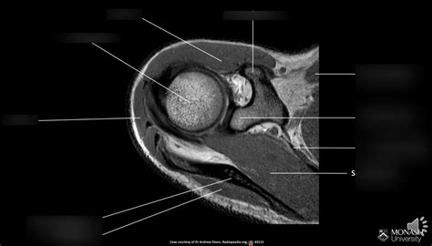 Diagram Of Mri Axial Slice Of Scapula Quizlet