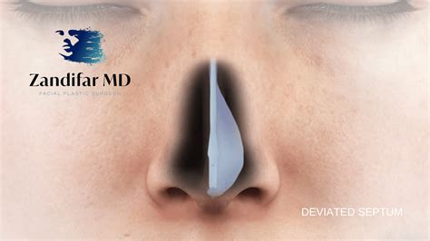 Signs Of A Deviated Septum