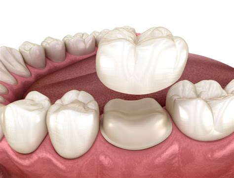 Dental Crowns In Boonsville Receding Gums Great Impression Dental