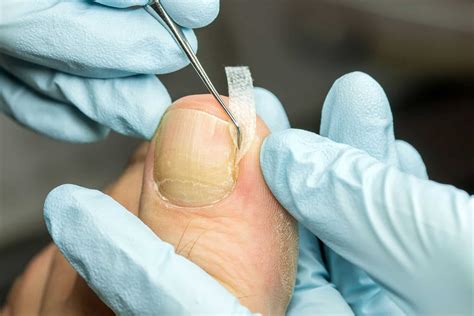 Soulager Un Ongle Incarn Avec Un Bain De Pied Au Bicarbonate