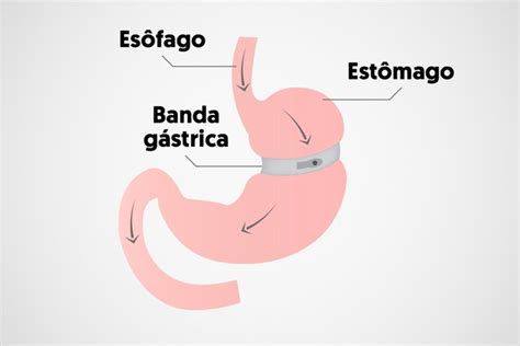 Cirurgia Bari Trica Tipos Quando Fazer Vantagens E Riscos Tua Sa De