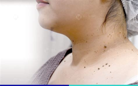 Skin Tags Can Be Treat In Treatment