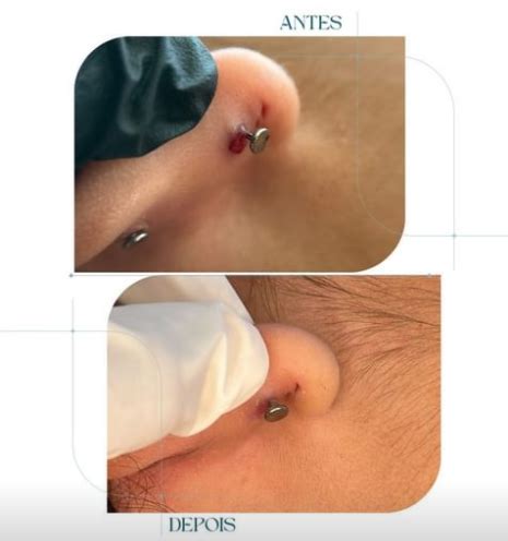 O que é granuloma Universo do Piercing