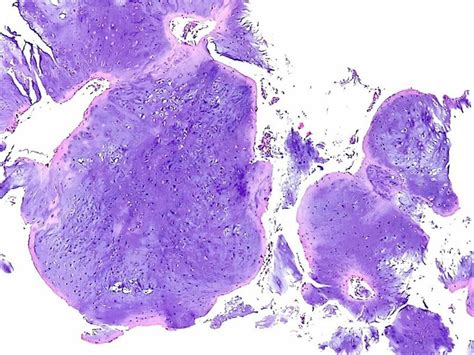 Enchondroma Lobules Of Hyaline Cartilage With Thin Mantle Of Fibrous