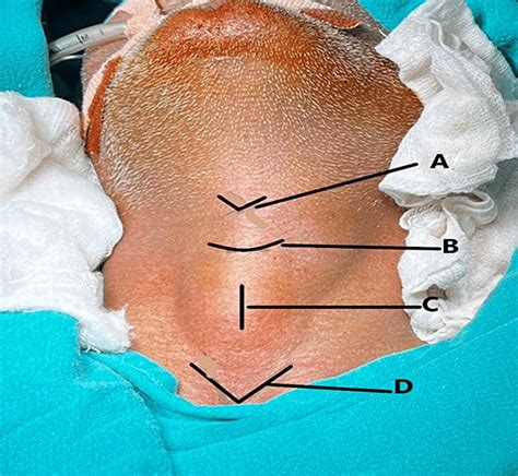 A Comparative Analysis Of Conventional Tracheotomy Versus Bjork Flap