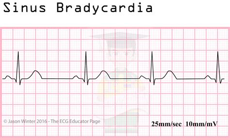 ECG Educator Blog Sinoatrial Node Rhythms