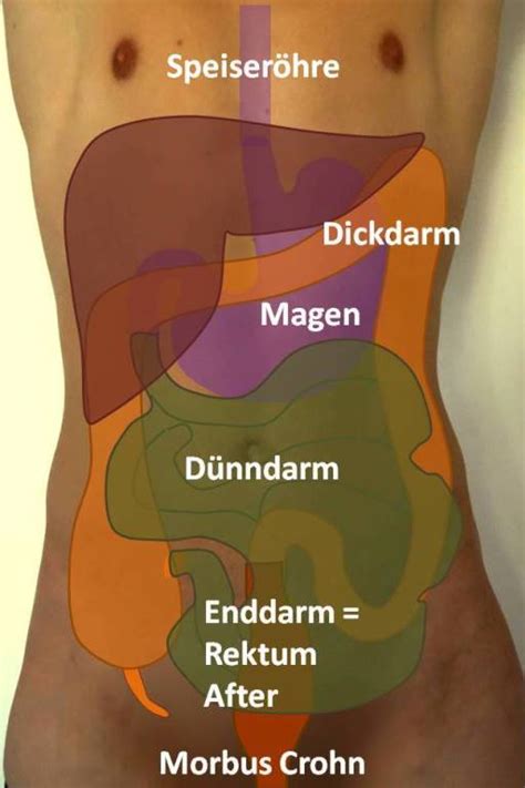 Morbus Crohn und Colitis ulcerosa OP in Nürnberg klinik hallerwiese de