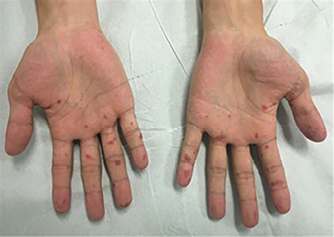 Idiopathic Thrombocytopenic Purpura Rash