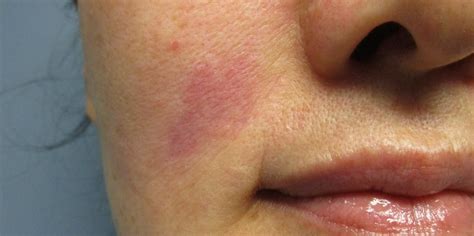 Birthmarks Removal Before And After Photos Dr Cameron Rokhsar