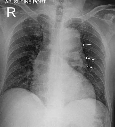 X Ray Images Of Aortic Tear
